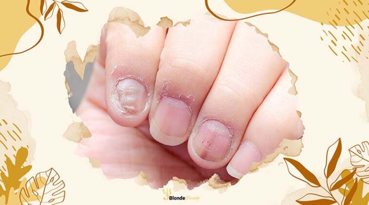 Why is My Nail Orange? Exploring Causes of Nail Discoloration - Blonde ...
