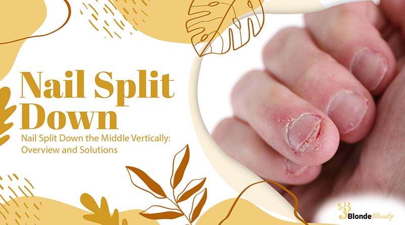 Nail Split Down the Middle Vertically: Overview and Solutions